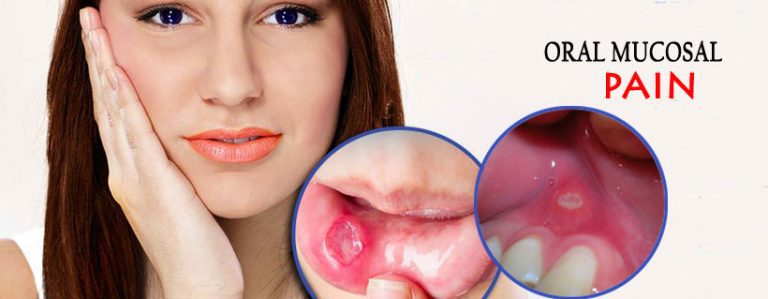 Oral Mucosal Pain – Causes, Diagnosis and Management