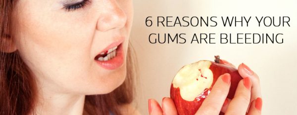 6 Reasons Why Your Gums Are Bleeding & How to Stop Them