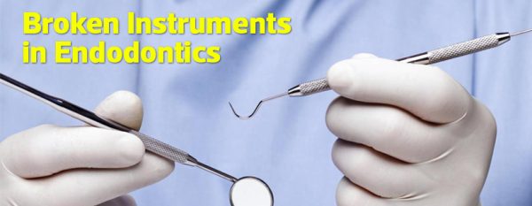 Complications in Endodontics, Part 1: Broken Instruments