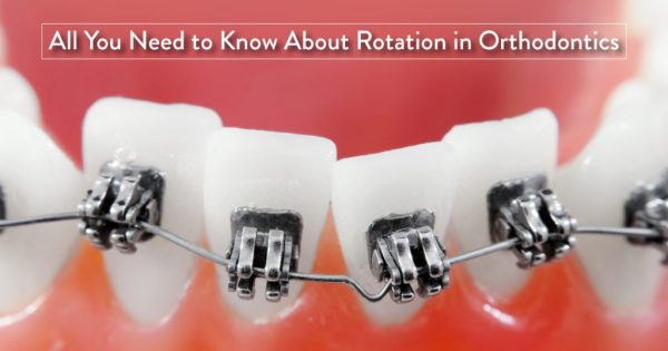 All You Need to Know About Rotation in Orthodontics