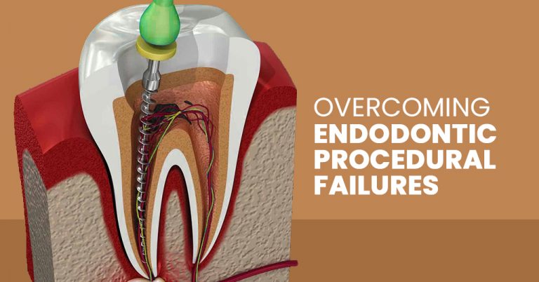 How to Successfully Overcome Endodontic Procedural Failures – ICPA ...
